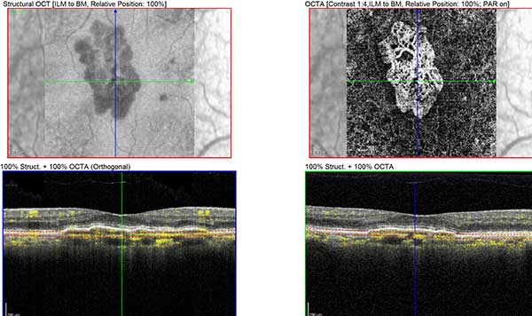 ANGIO-OCT - Studio Oculistico Gualdi Roma - Centro Doma